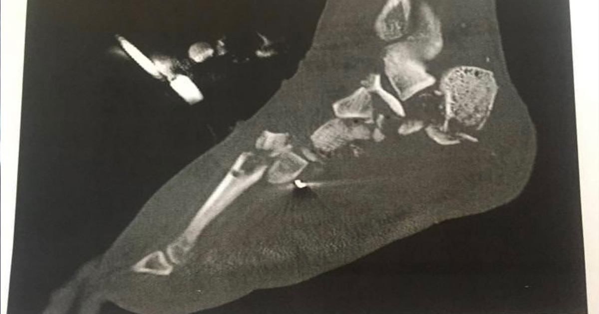 Guy Has Leg Amputated, Serves Friends Tacos Filled With His Foot Meat ...